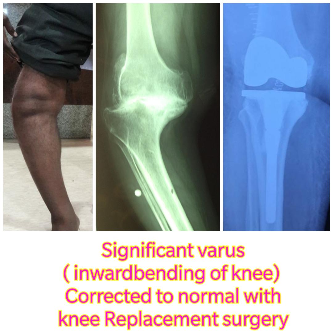 Significant inward bent knee (Varus deformity) corrected fully to ...